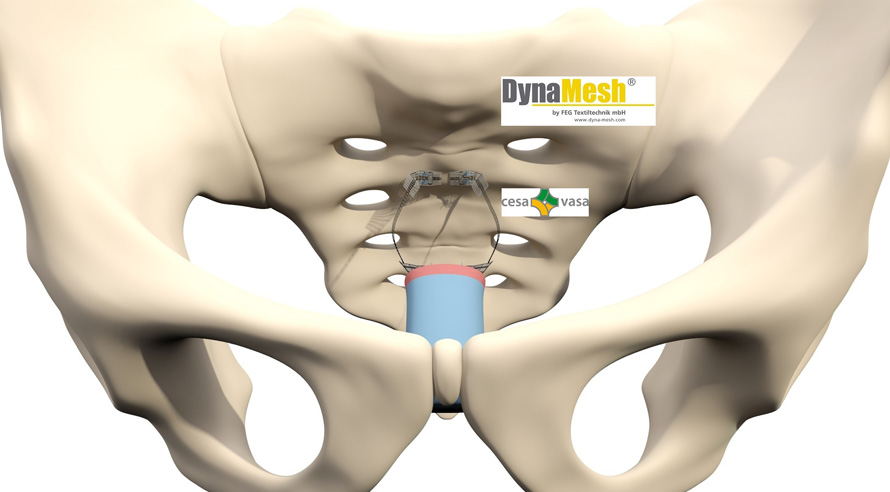 Dynamesh Cesa Vasa Surgical Mesh Implants Pelvic Floor Kebomed