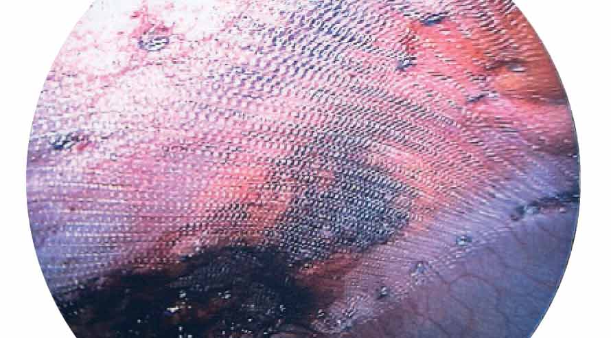 DynaMesh IPOM - Surgical Mesh Implants - Hernias - Kebomed